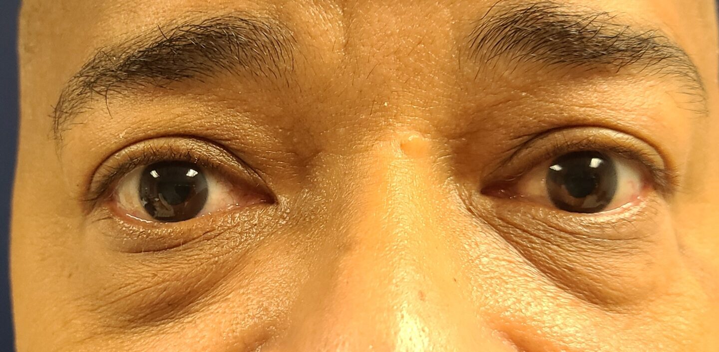 Eyelid Fat Pockets | DC Cosmetics